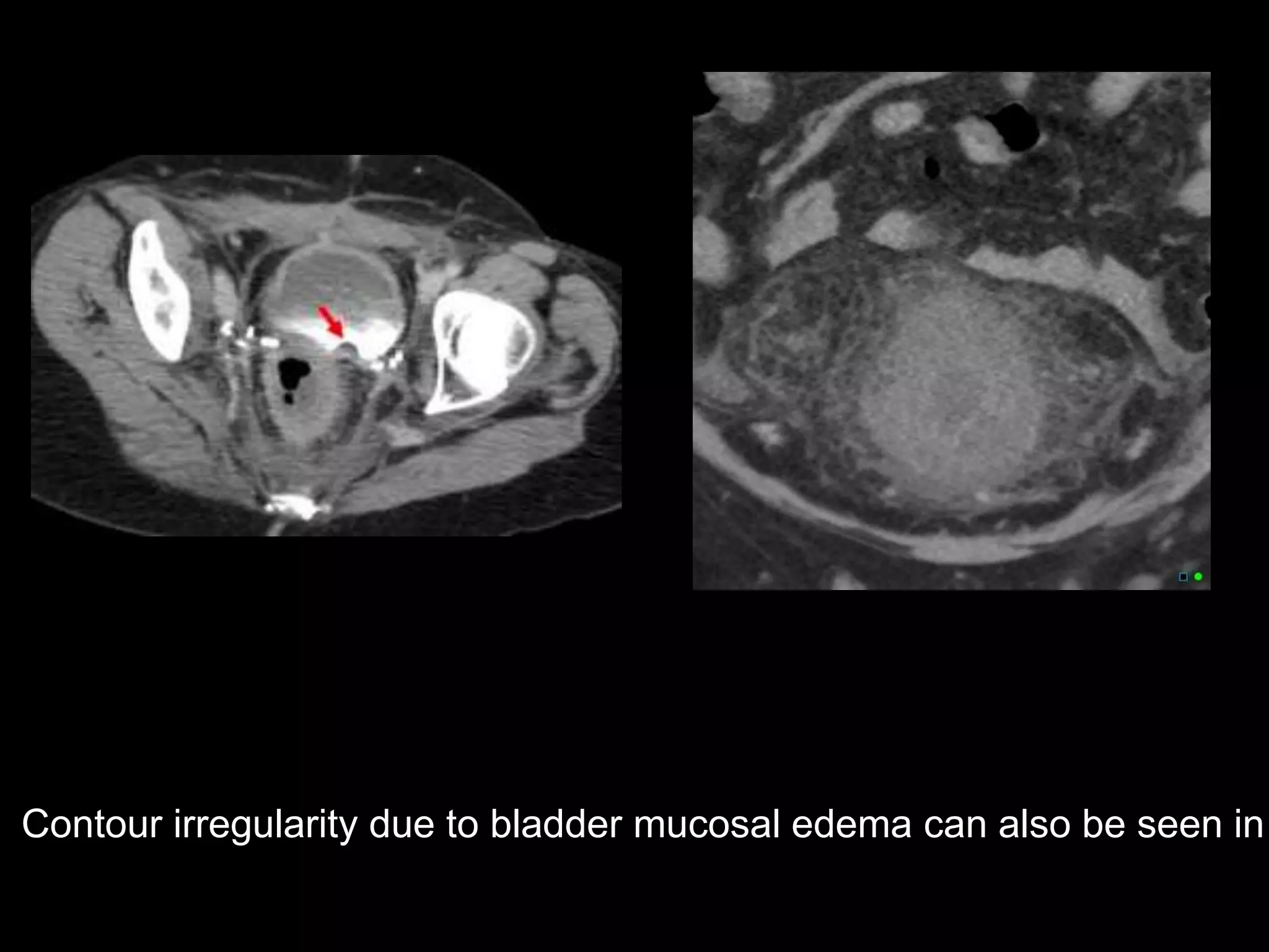 Imaging of urinary bladder and urethra | PPTX