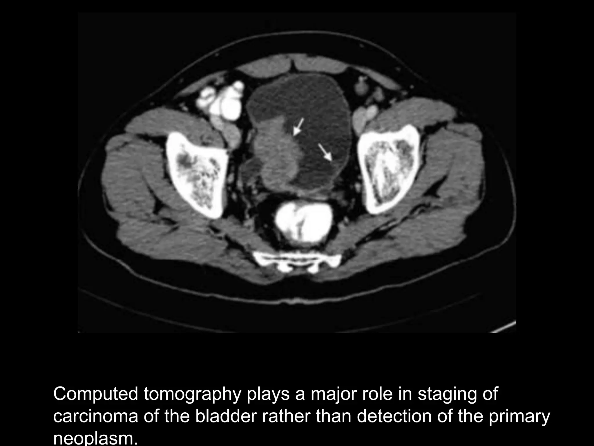 Imaging of urinary bladder and urethra | PPTX