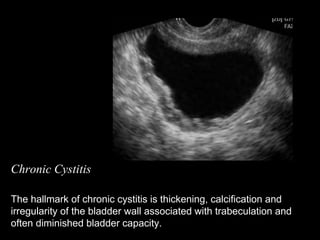 Bladder Trabeculation