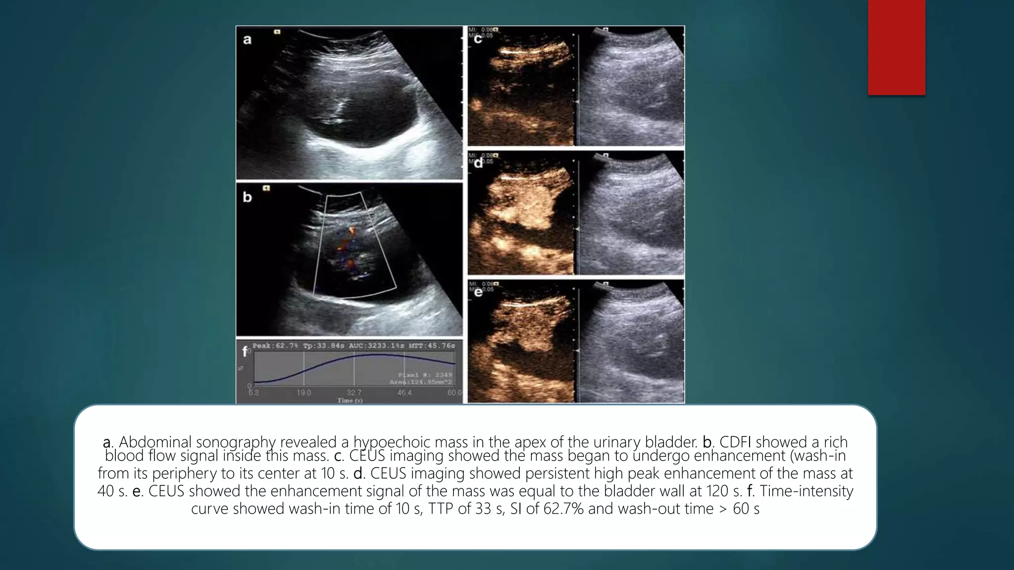 Imaging of urinary bladder malignancy | PPTX