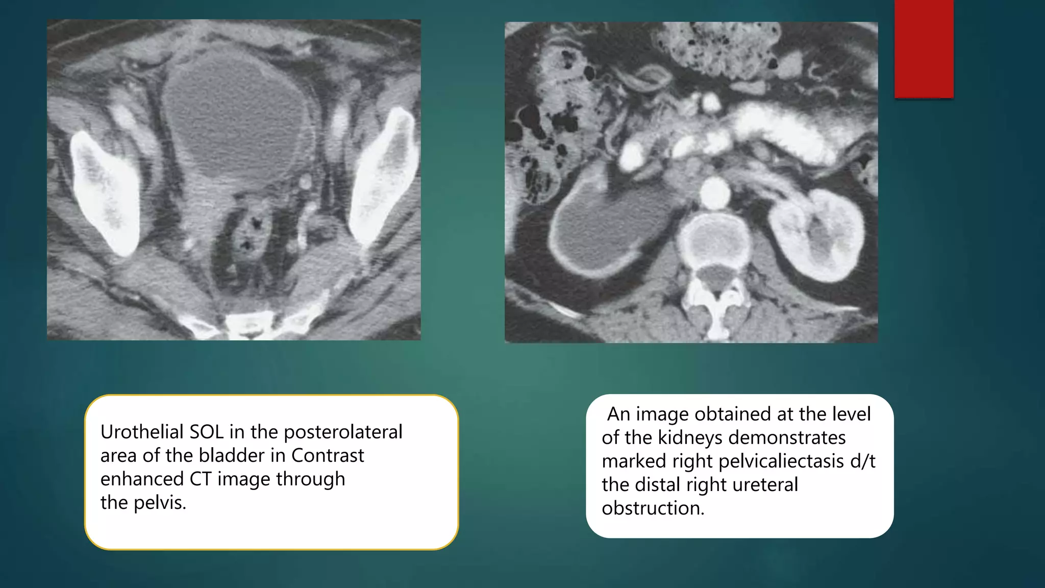 Imaging of urinary bladder malignancy | PPTX