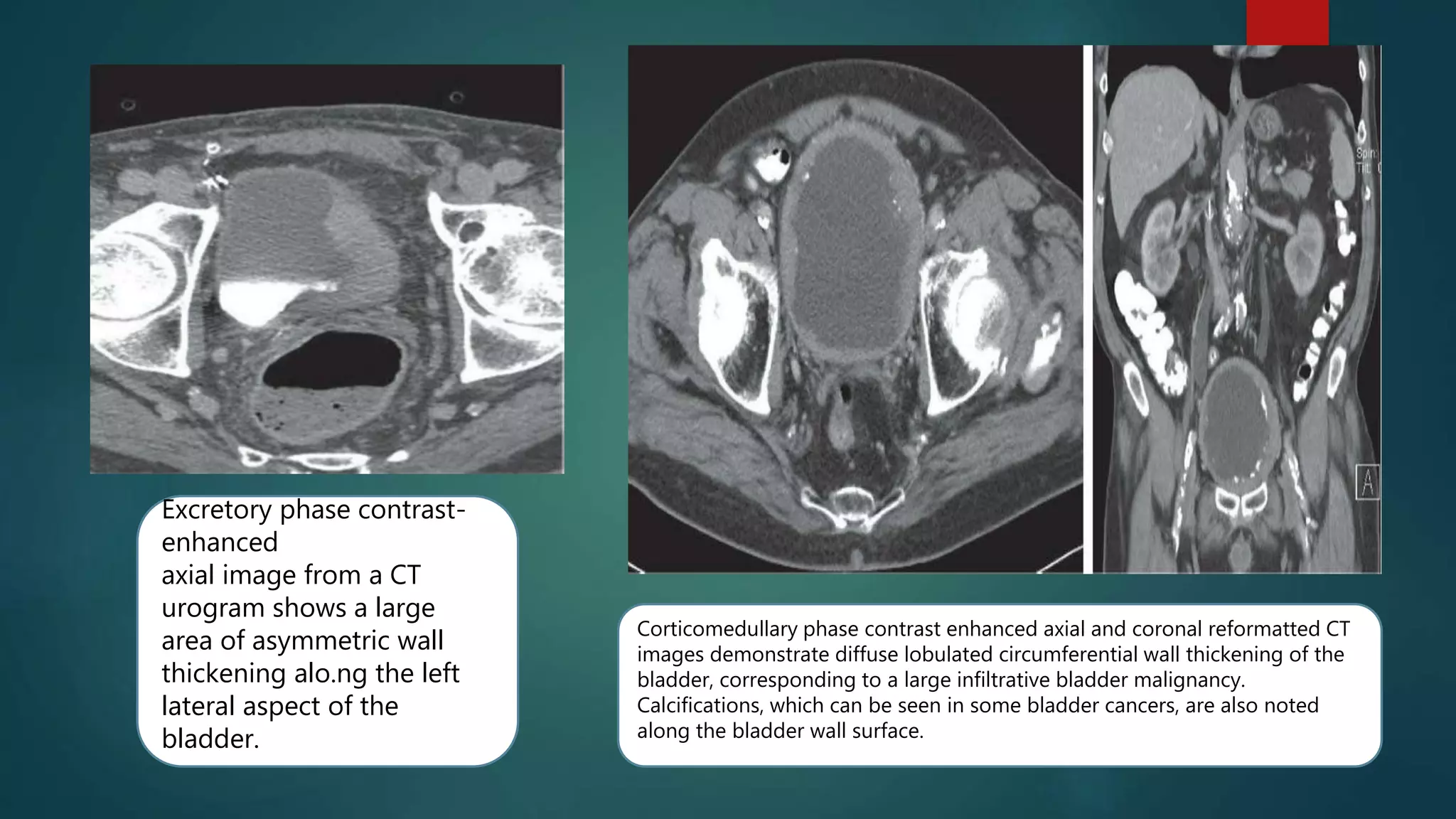 Imaging of urinary bladder malignancy | PPTX
