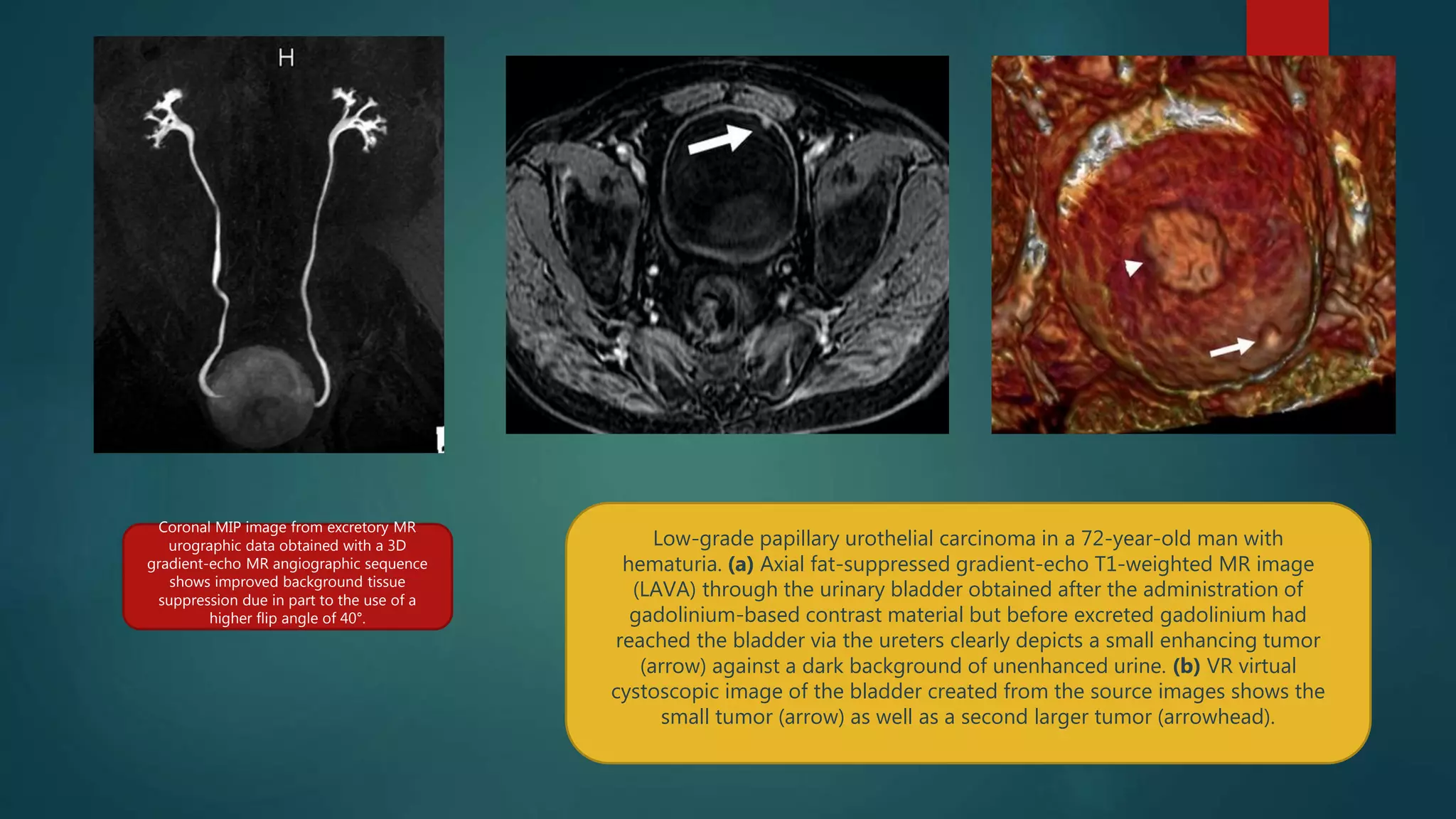 Imaging of urinary bladder malignancy | PPTX