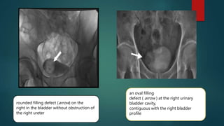 Imaging of urinary bladder malignancy | PPTX