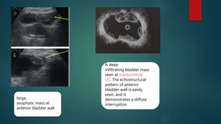 Imaging of urinary bladder malignancy | PPTX