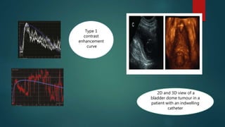 Imaging of urinary bladder malignancy | PPTX