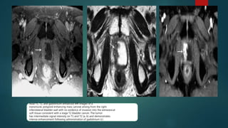 Imaging of urinary bladder malignancy | PPTX