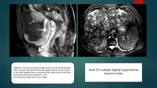 Imaging of urinary bladder malignancy | PPTX