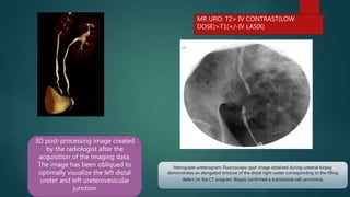 Imaging of urinary bladder malignancy | PPTX