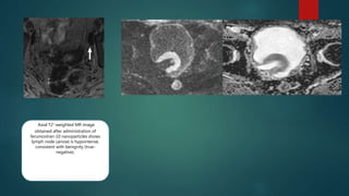 Imaging of urinary bladder malignancy | PPTX