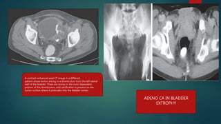 Imaging of urinary bladder malignancy | PPTX