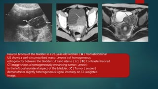 Imaging of urinary bladder malignancy | PPTX