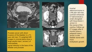 Imaging of urinary bladder malignancy | PPTX