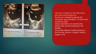 Imaging of urinary bladder malignancy | PPTX