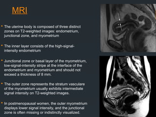 Imaging of uterine disorders radiology.pptx