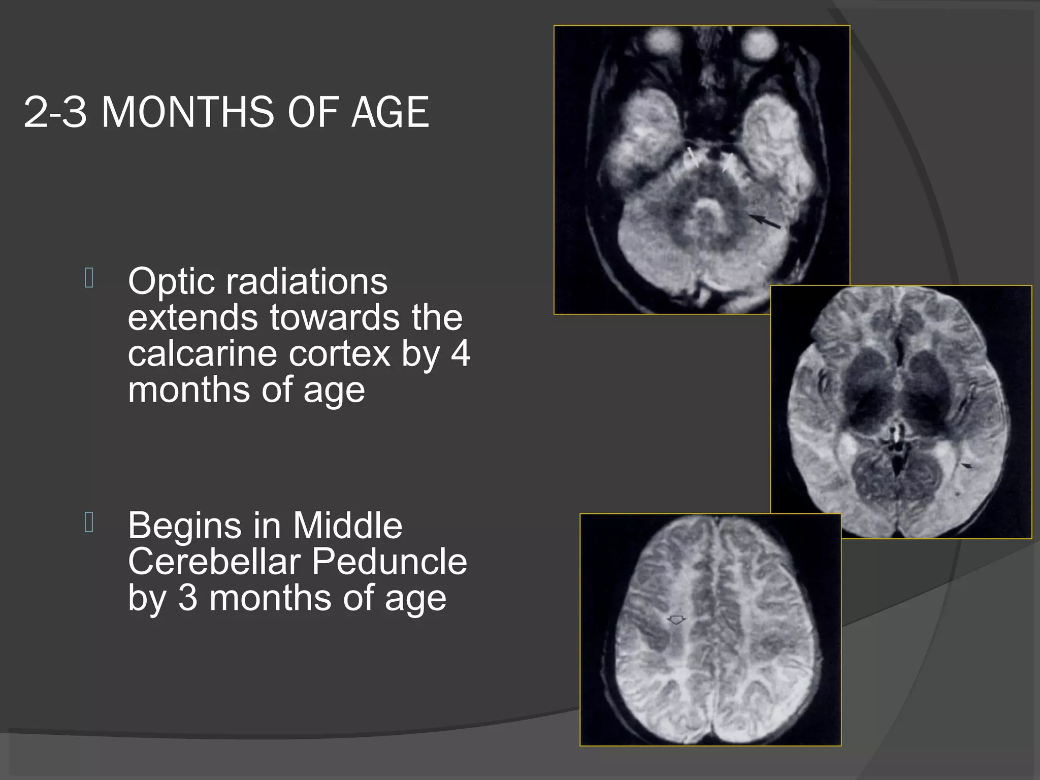 Imaging of white matter diseases | PPT