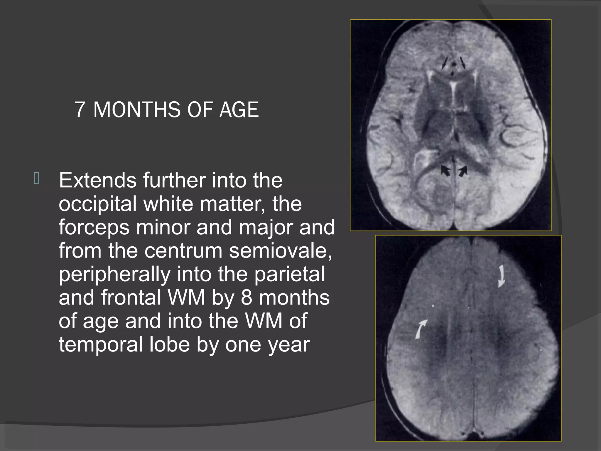 Imaging of white matter diseases | PPT