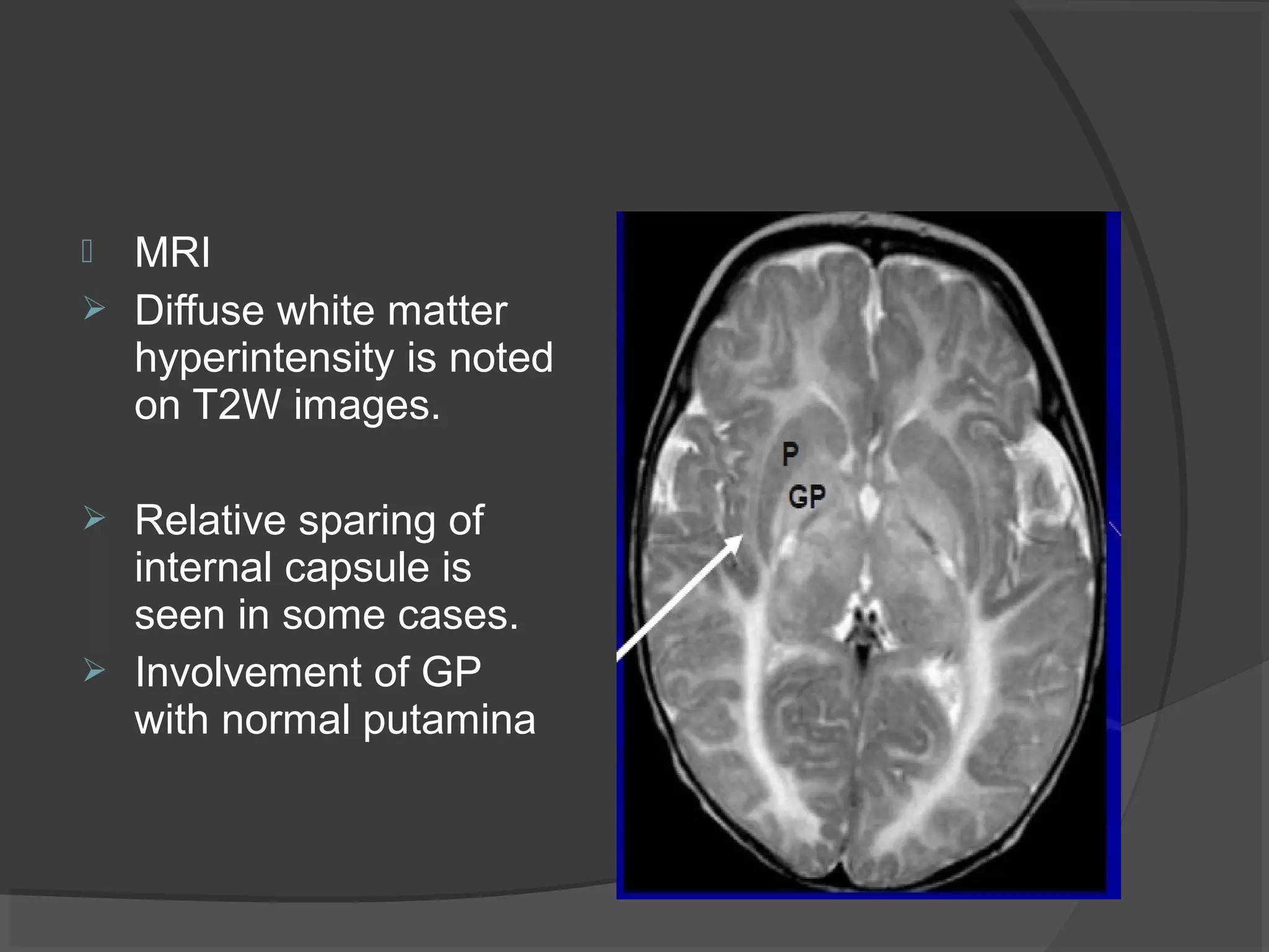 Imaging of white matter diseases | PPT