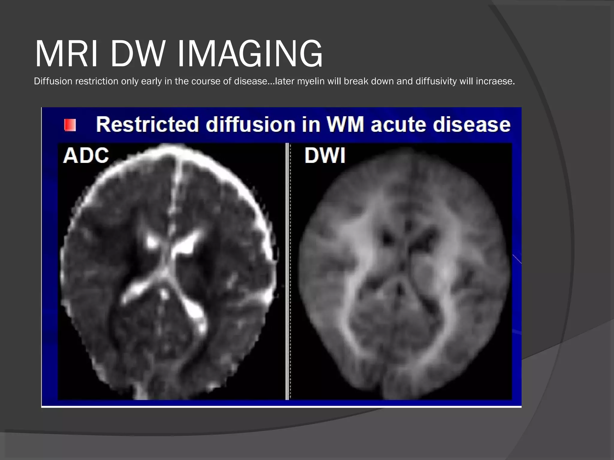 Imaging of white matter diseases | PPT
