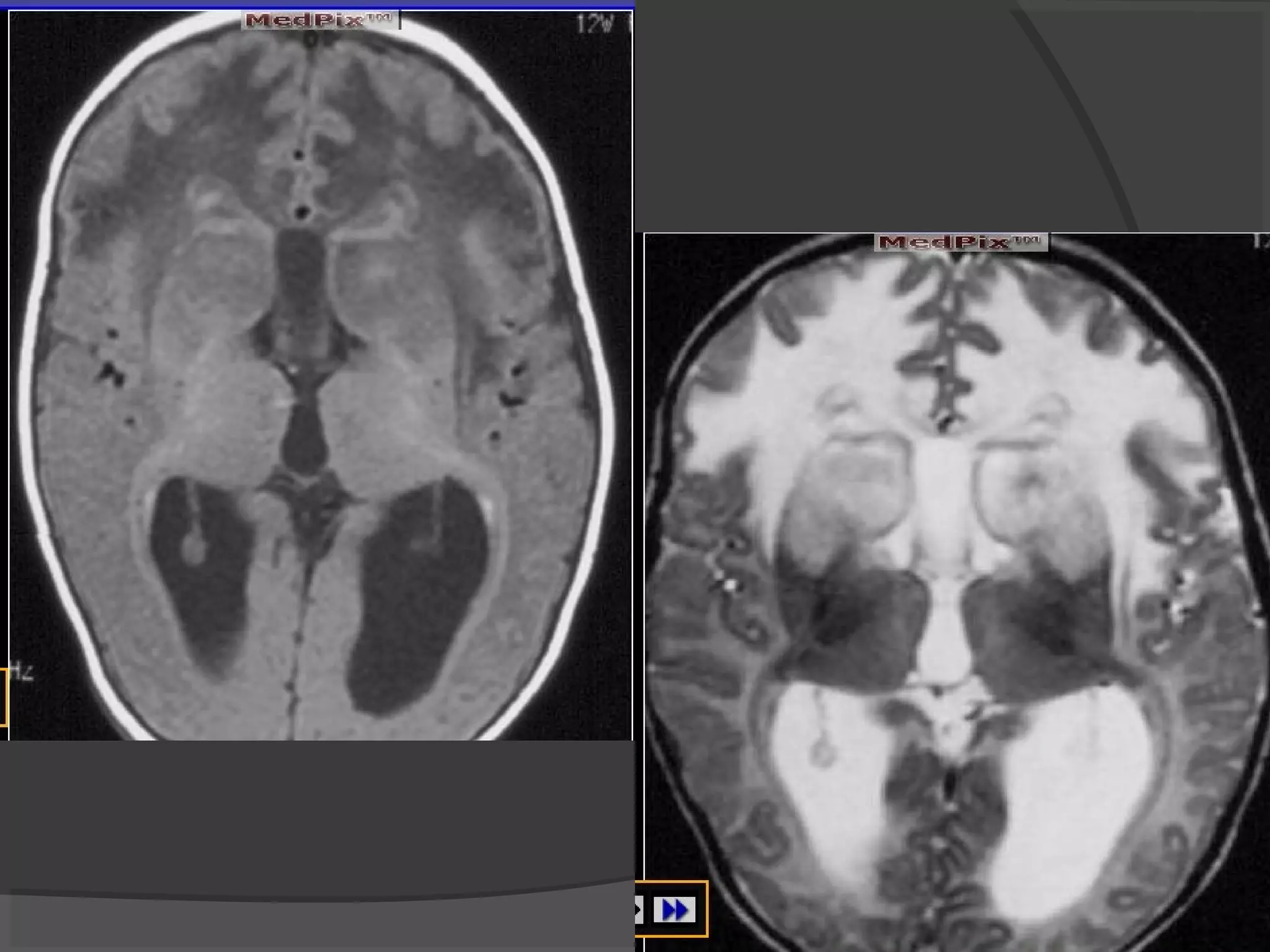 Imaging of white matter diseases | PPT