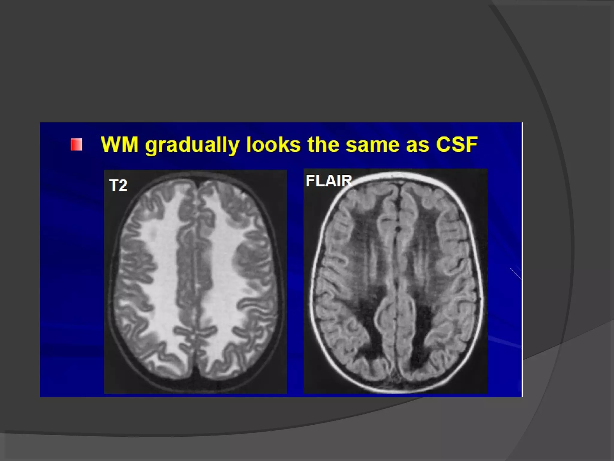 Imaging of white matter diseases | PPT