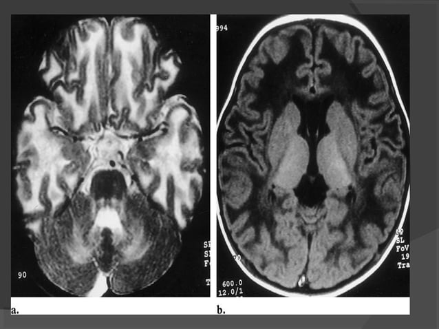 Imaging of white matter diseases | PPT | Brain and Nervous System ...