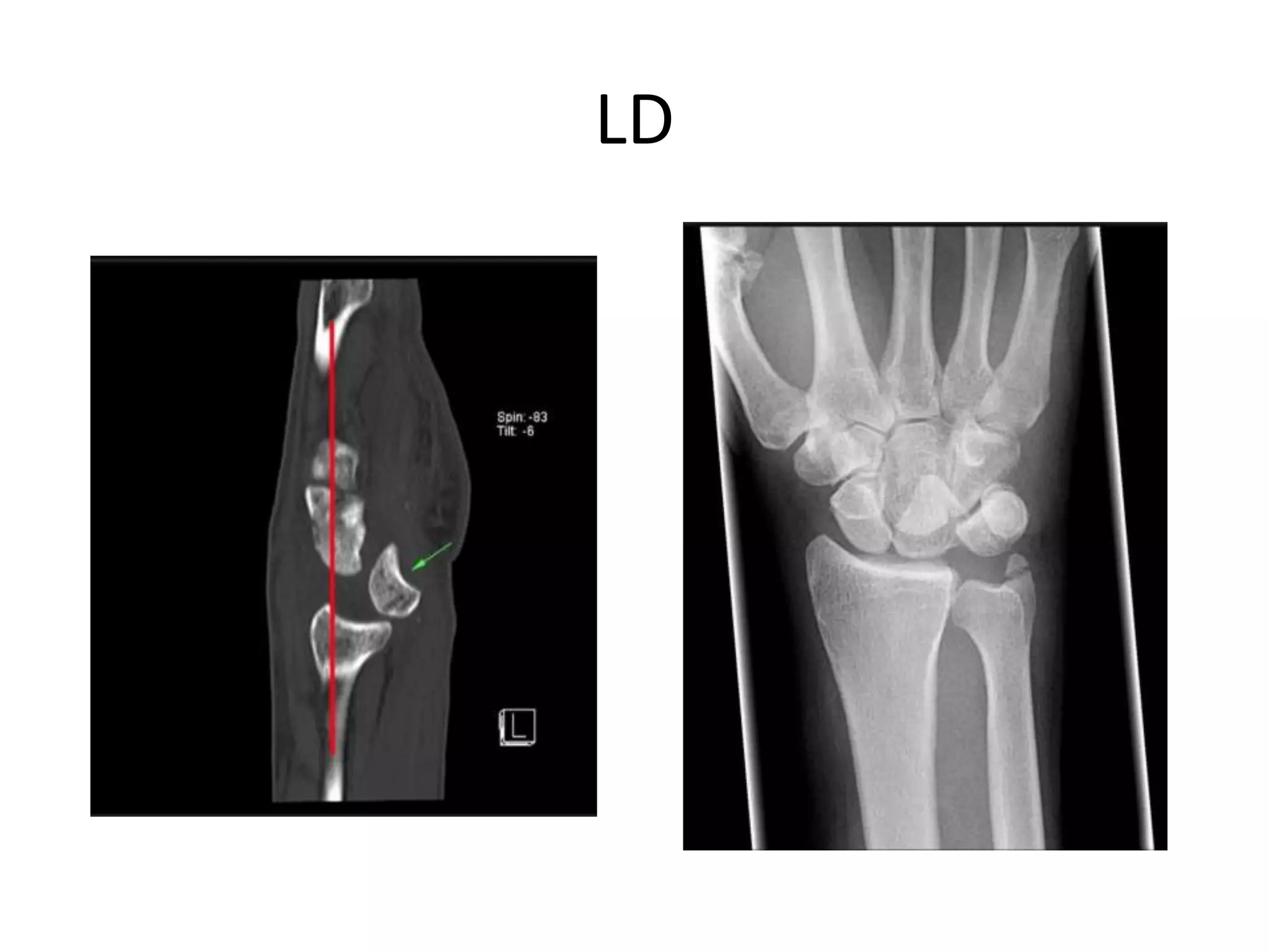 Imaging of wrist joint | PPTX