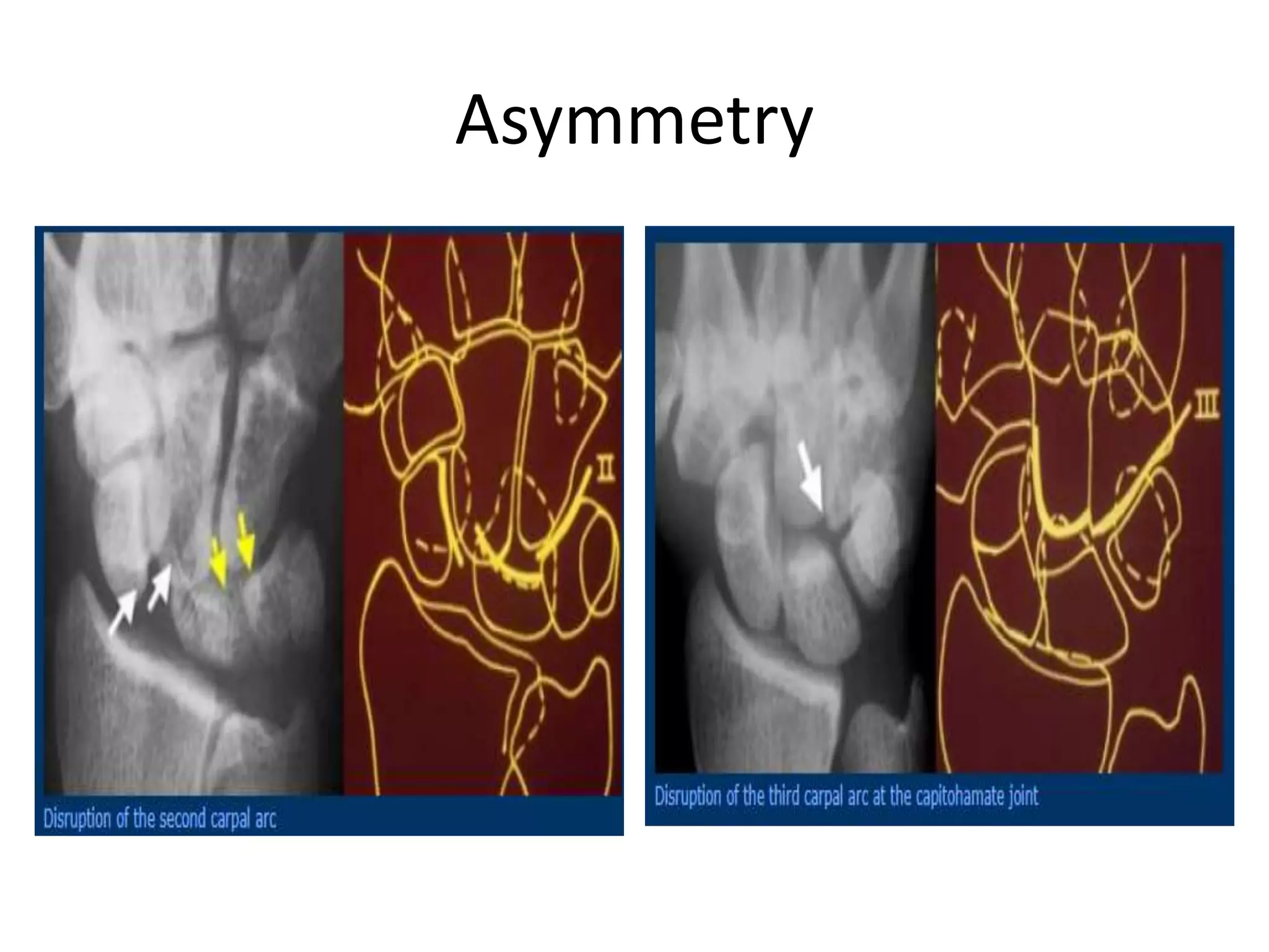 Imaging of wrist joint | PPTX