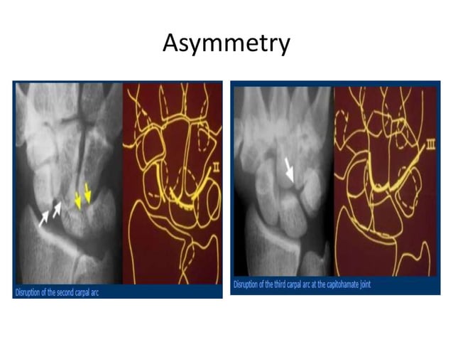 Imaging of wrist joint | PPTX