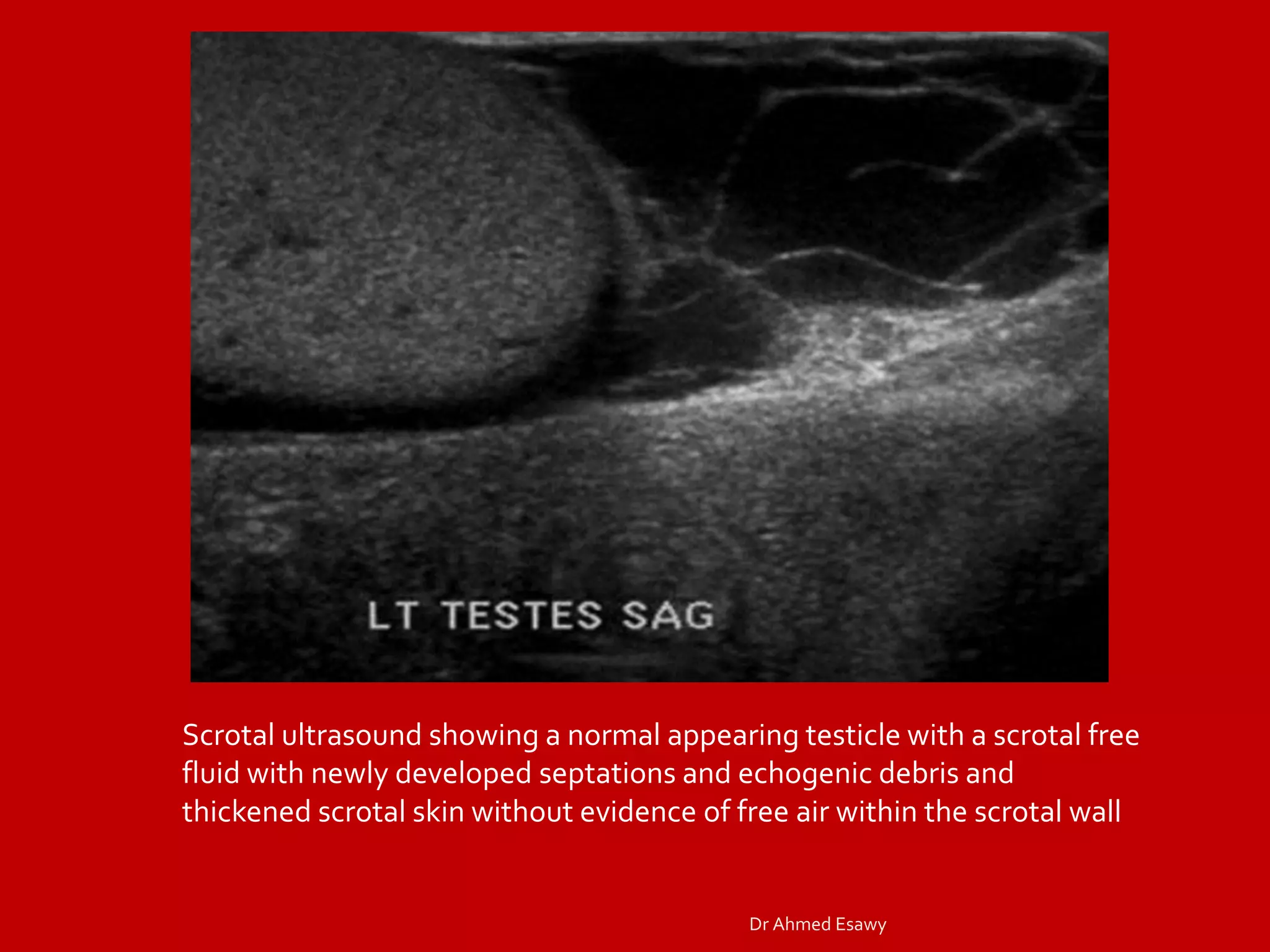 Imaging orchitis epidydmitis epidydmo orchitis DrAhmed Esawy | PDF