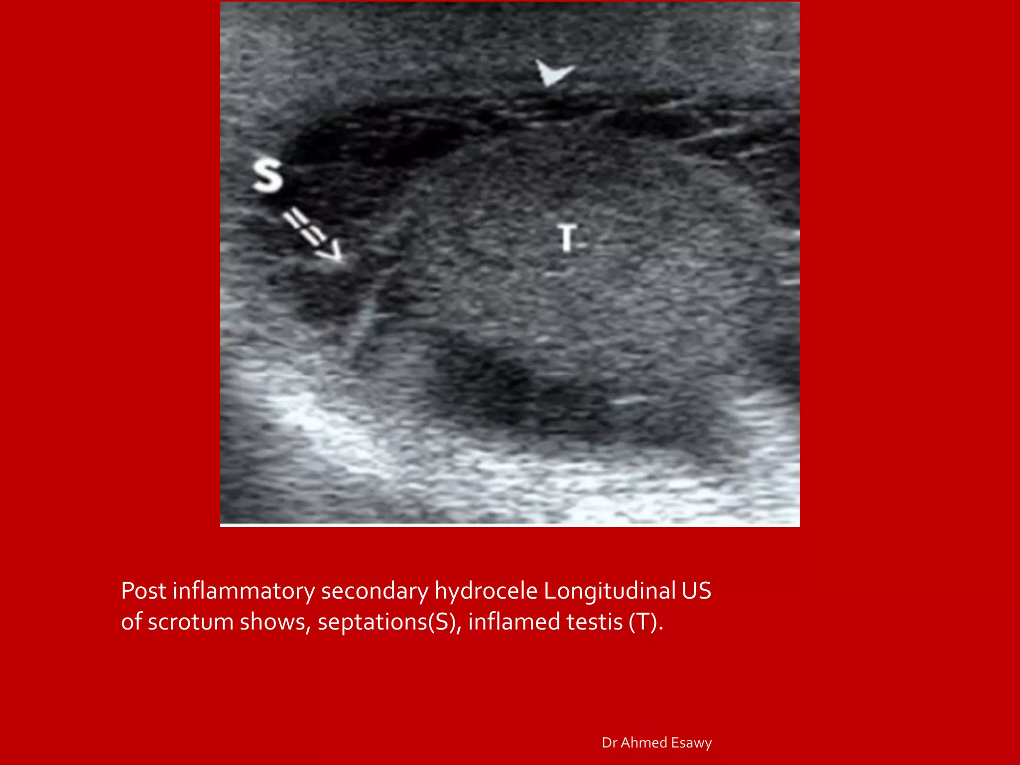 Imaging orchitis epidydmitis epidydmo orchitis DrAhmed Esawy | PDF