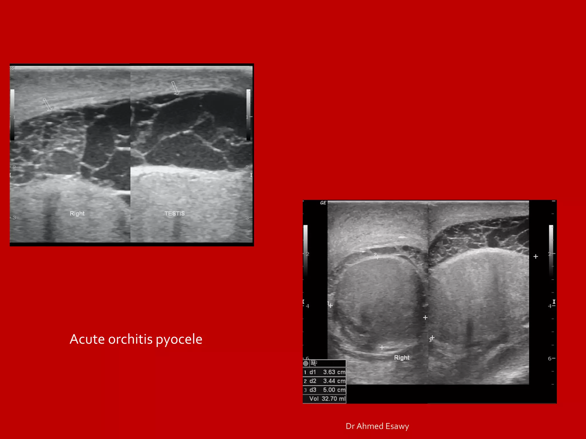 Imaging orchitis epidydmitis epidydmo orchitis DrAhmed Esawy | PDF