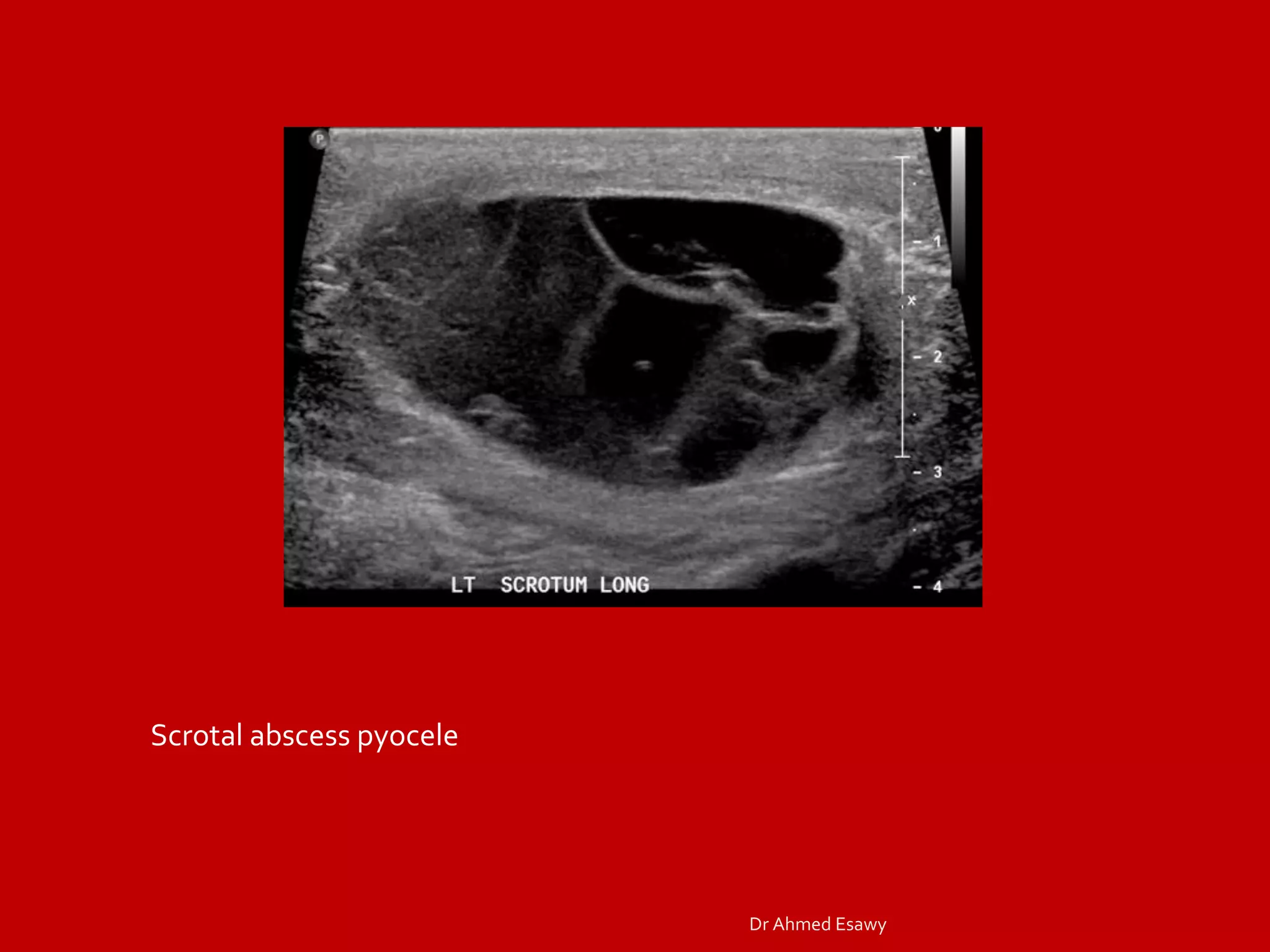 Imaging orchitis epidydmitis epidydmo orchitis DrAhmed Esawy | PDF