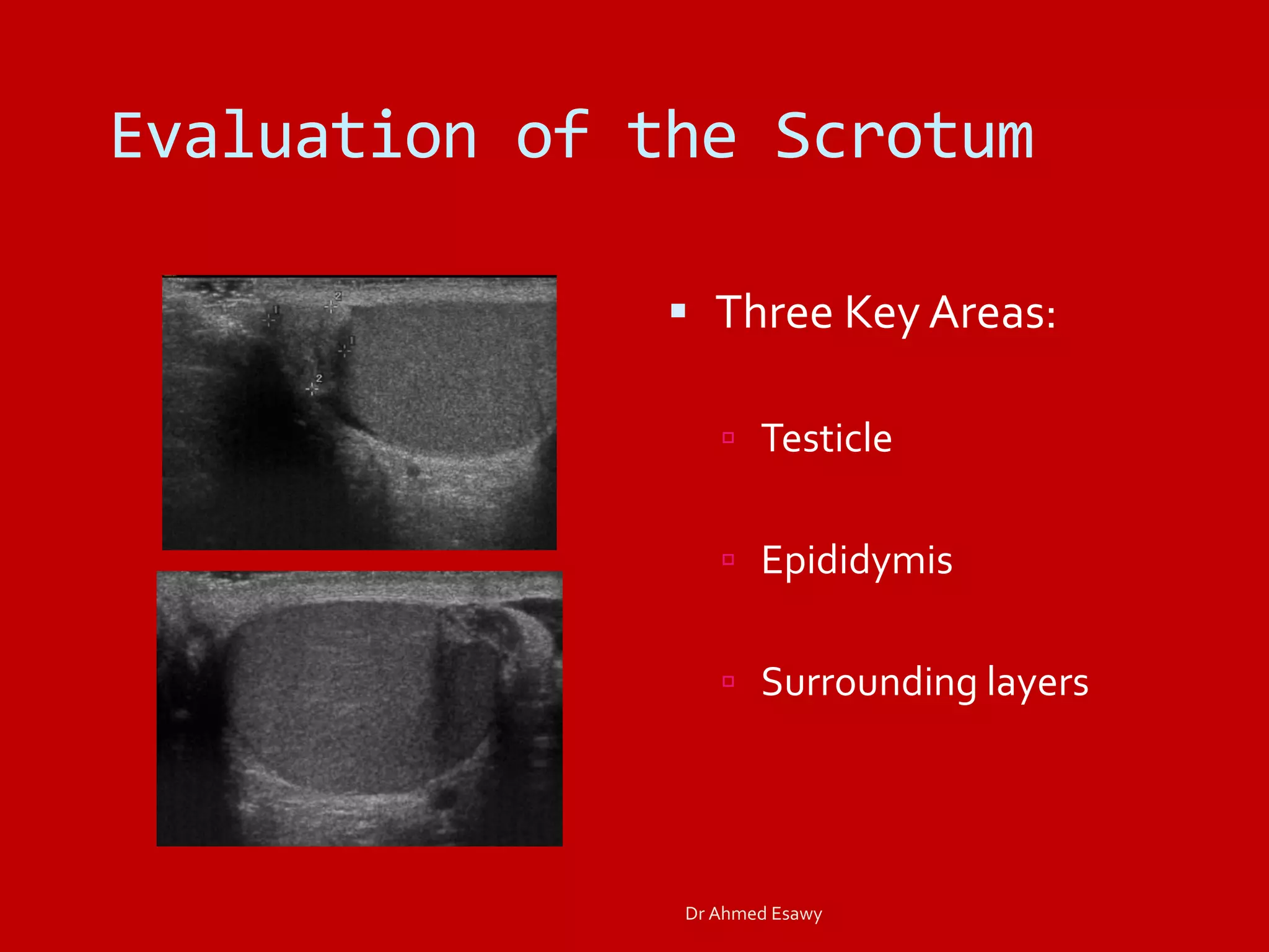 Imaging orchitis epidydmitis epidydmo orchitis DrAhmed Esawy | PDF