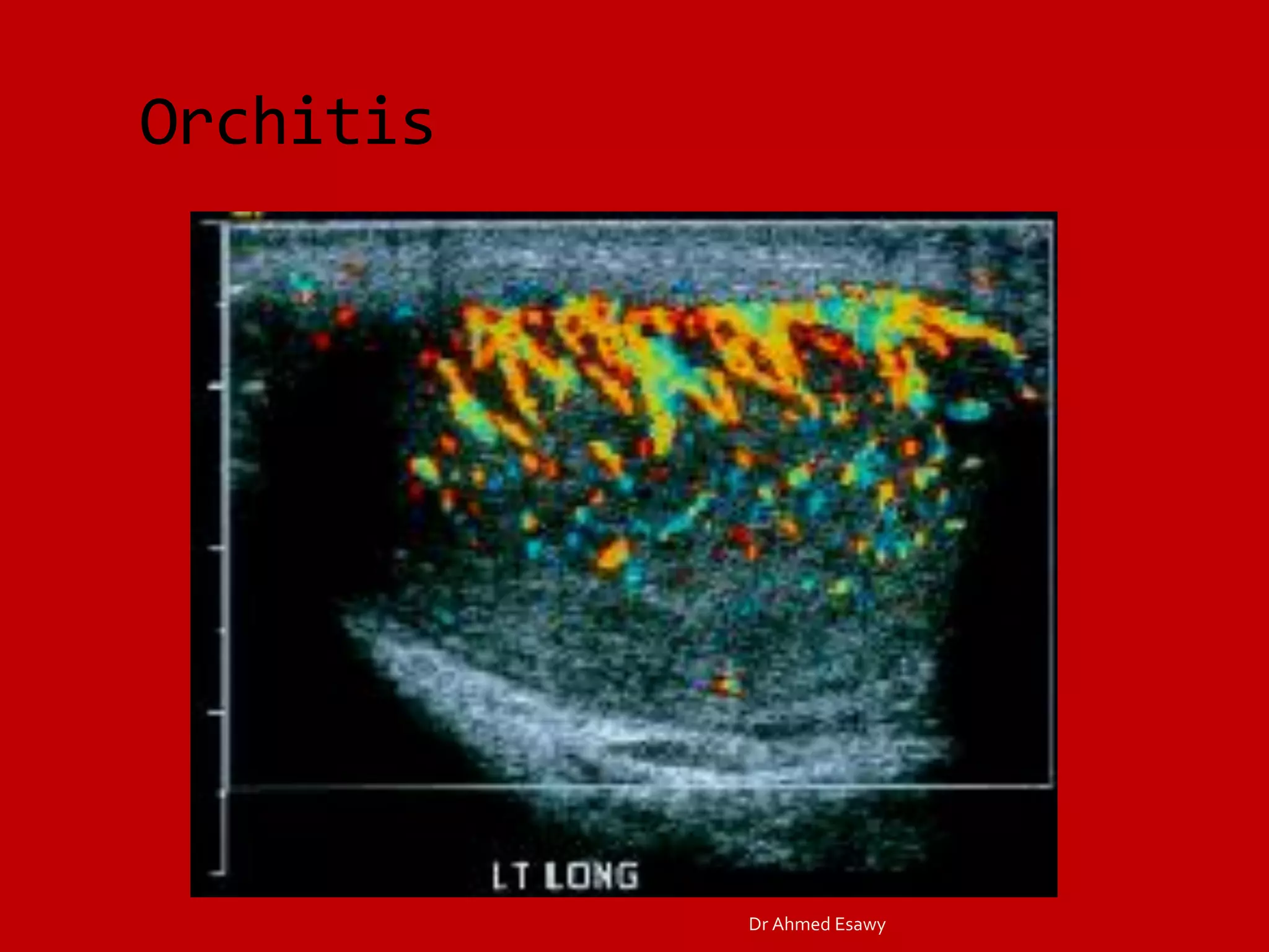 Imaging orchitis epidydmitis epidydmo orchitis DrAhmed Esawy | PDF