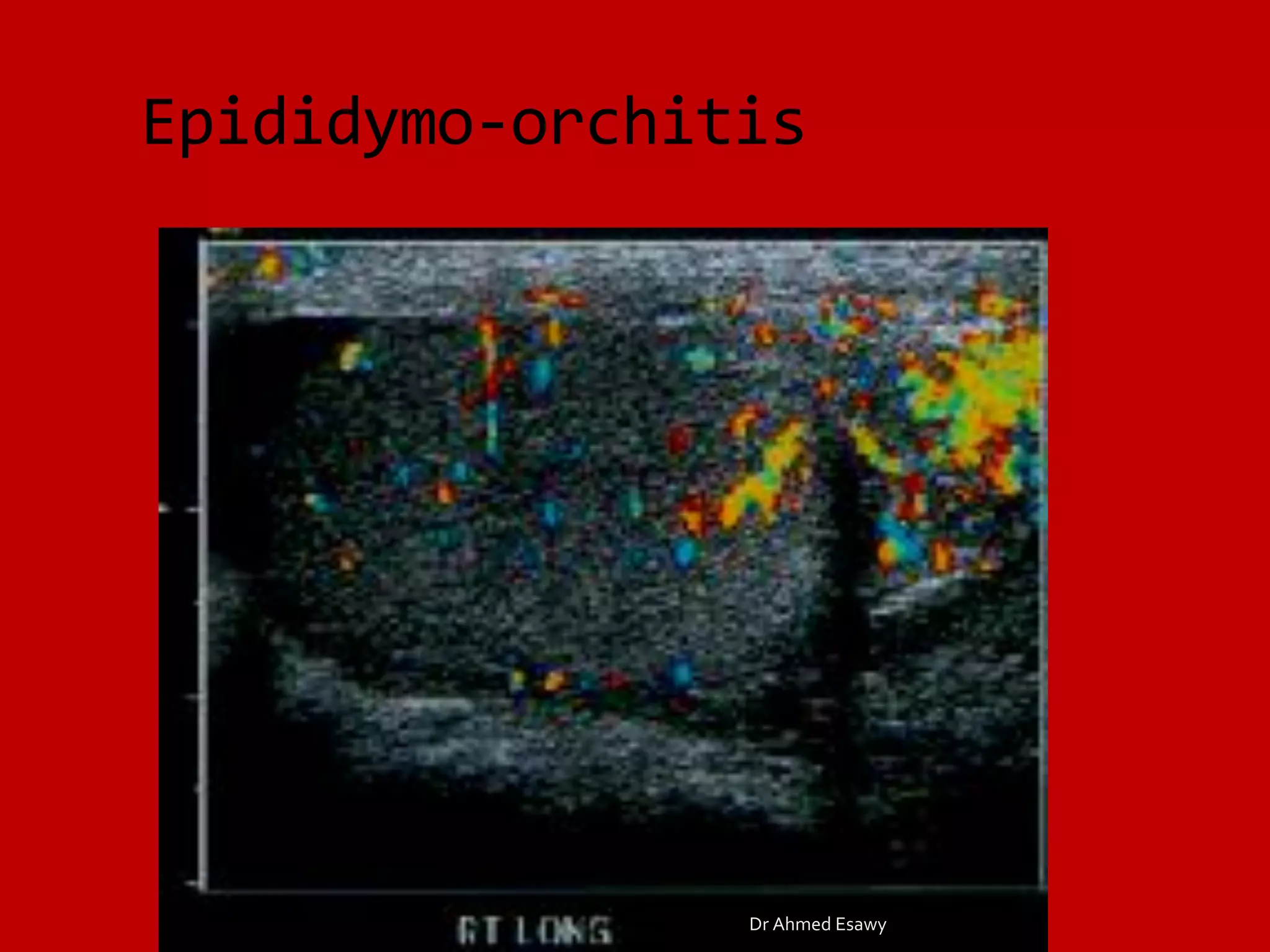 Imaging orchitis epidydmitis epidydmo orchitis DrAhmed Esawy | PDF