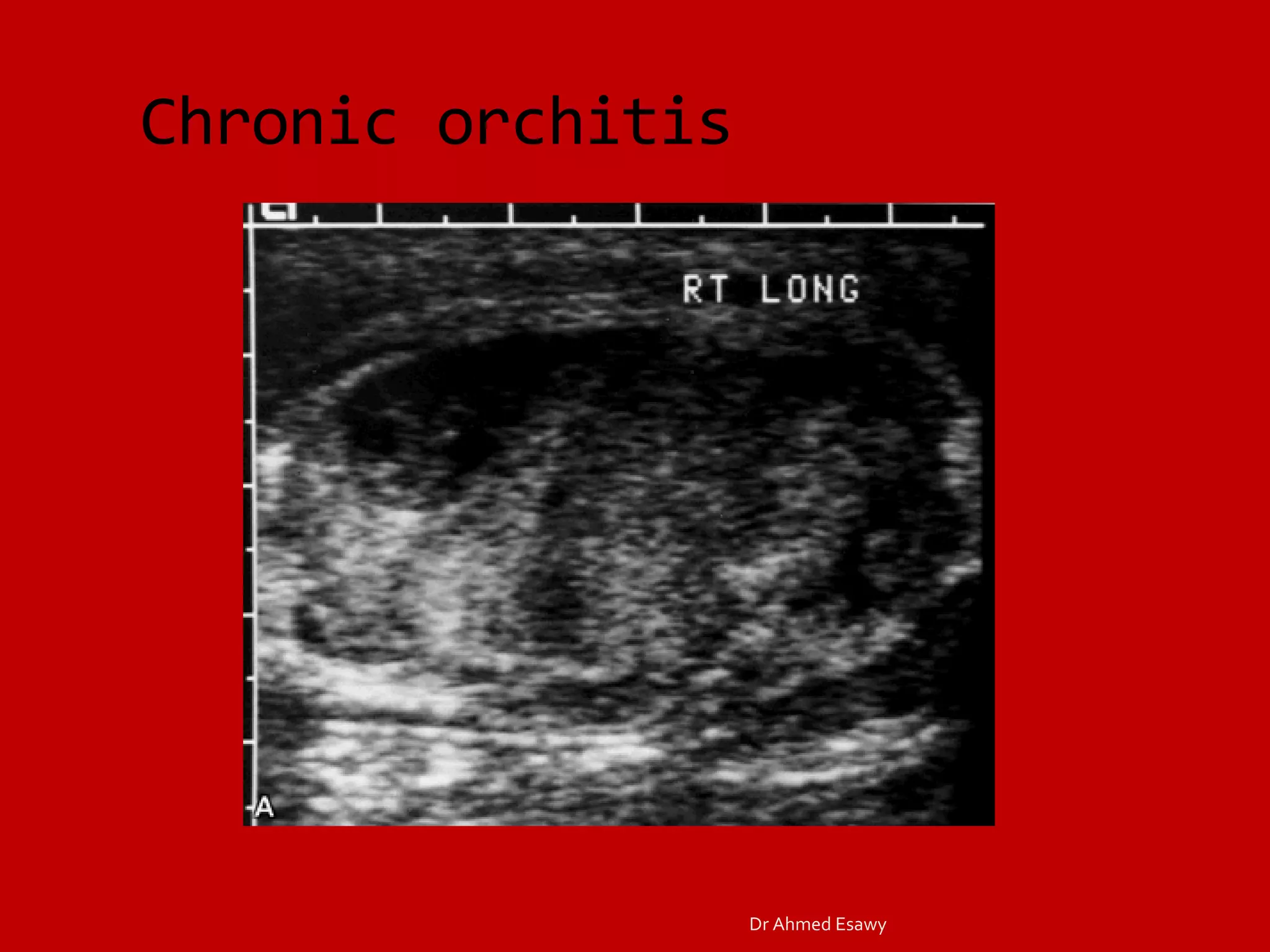 Imaging orchitis epidydmitis epidydmo orchitis DrAhmed Esawy | PDF
