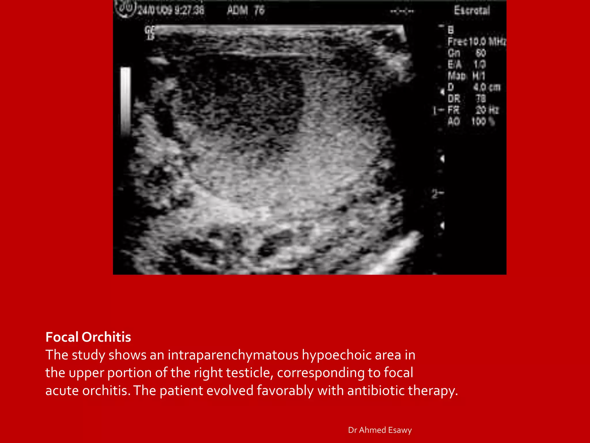 Imaging orchitis epidydmitis epidydmo orchitis DrAhmed Esawy | PDF
