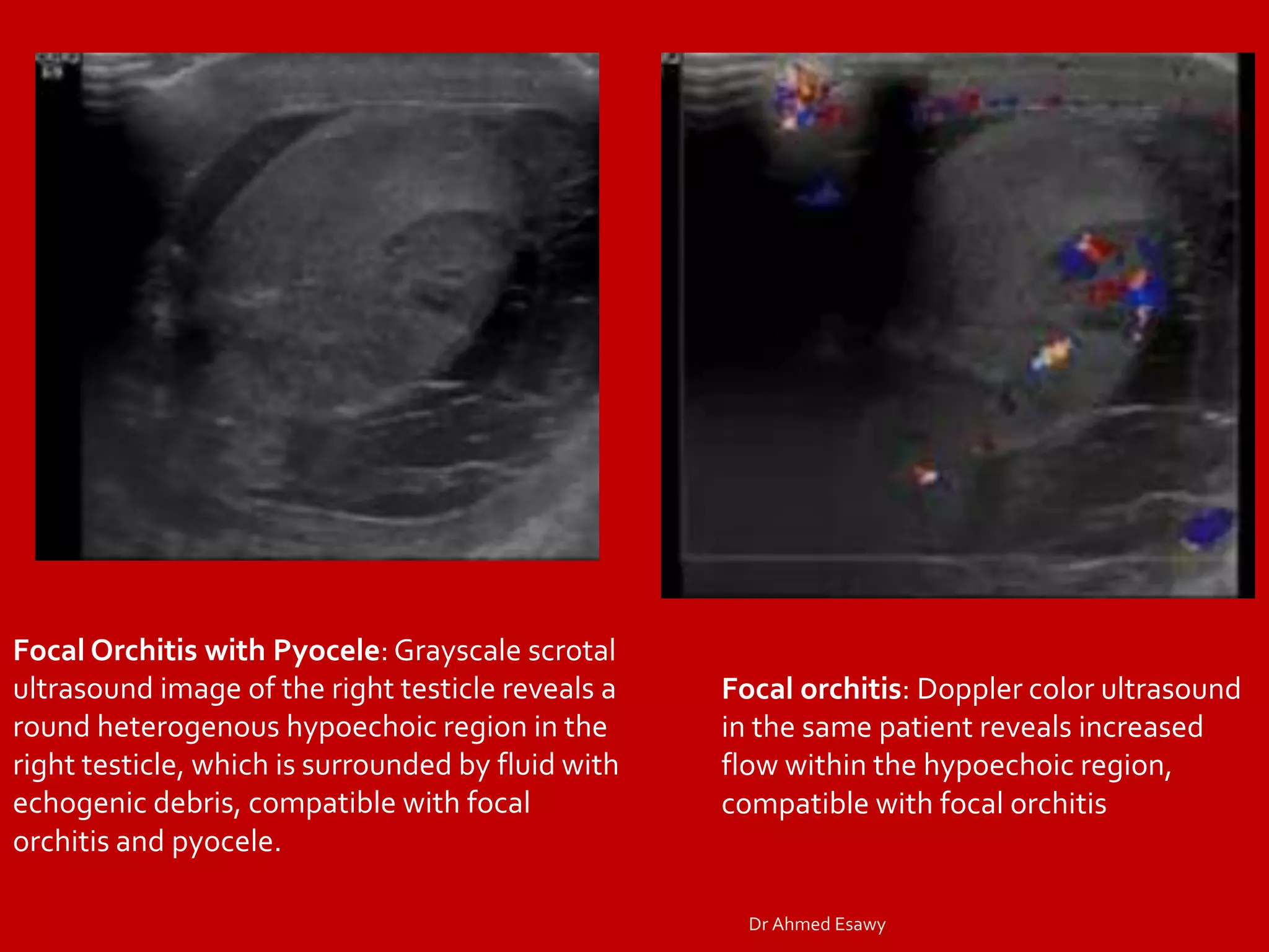 Imaging orchitis epidydmitis epidydmo orchitis DrAhmed Esawy | PDF