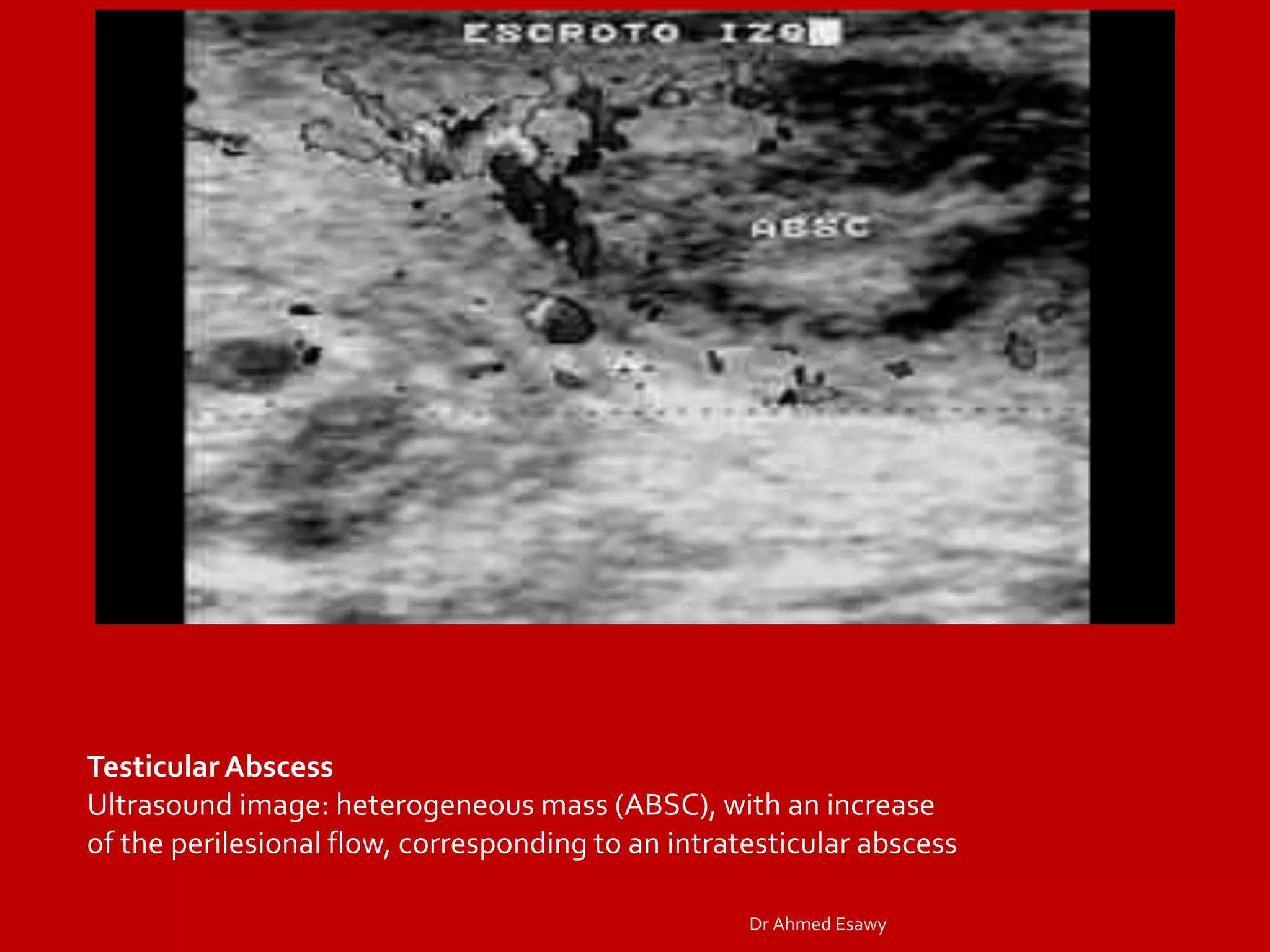 Imaging orchitis epidydmitis epidydmo orchitis DrAhmed Esawy | PDF