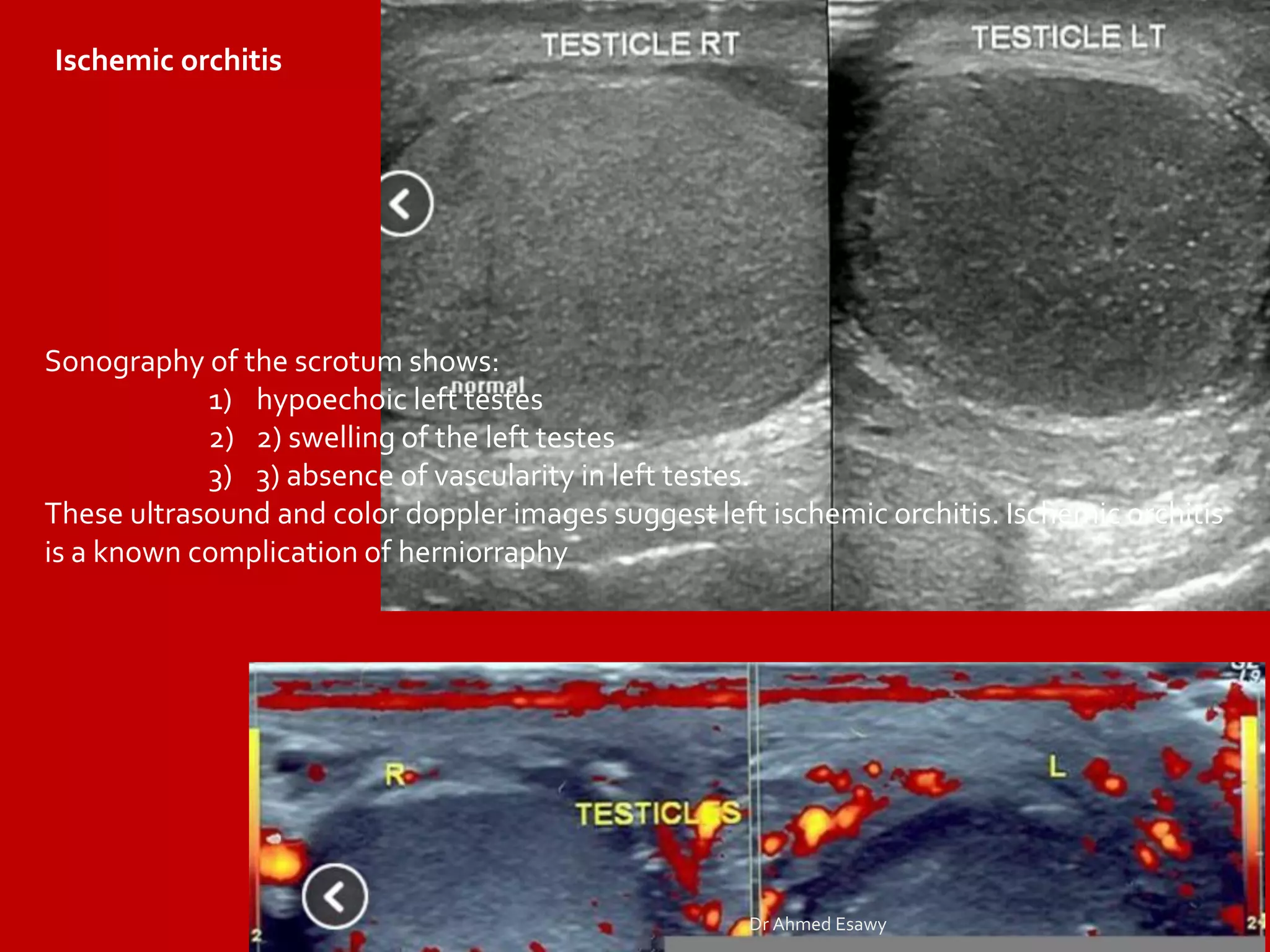 Imaging orchitis epidydmitis epidydmo orchitis DrAhmed Esawy | PDF