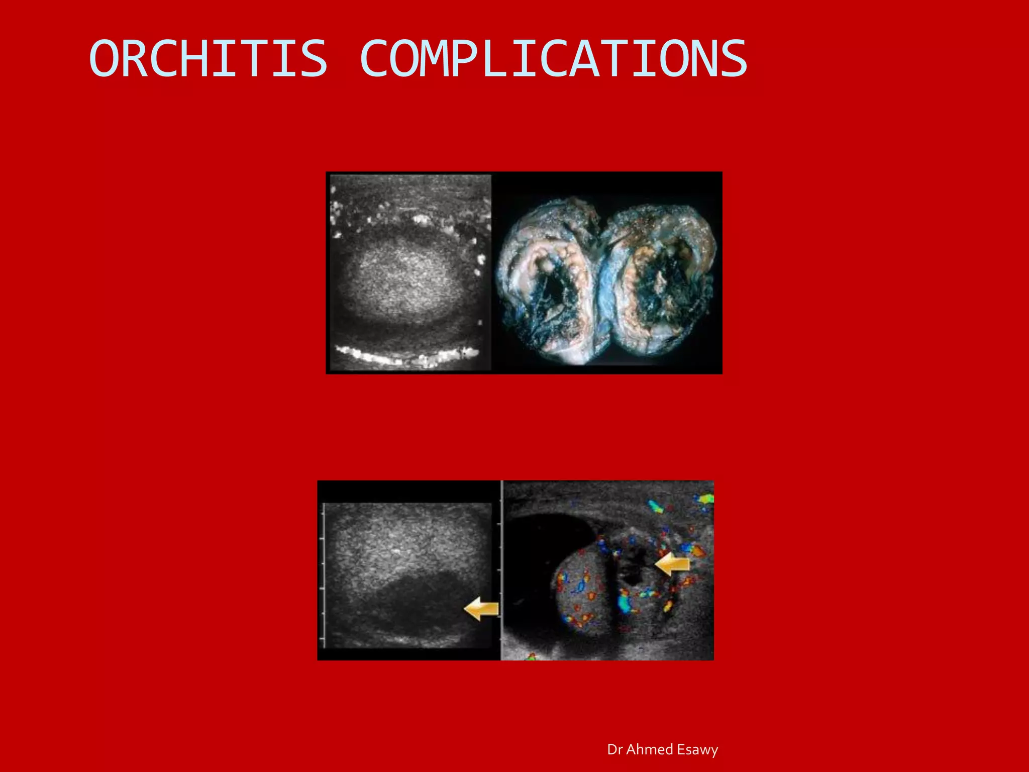 Imaging orchitis epidydmitis epidydmo orchitis DrAhmed Esawy | PDF