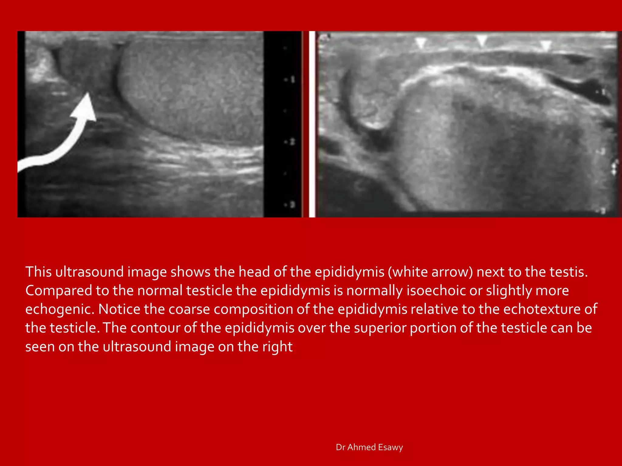 Imaging orchitis epidydmitis epidydmo orchitis DrAhmed Esawy | PDF