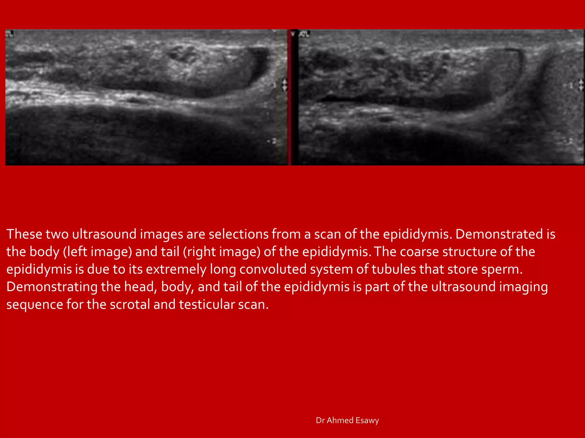 Imaging orchitis epidydmitis epidydmo orchitis DrAhmed Esawy | PDF