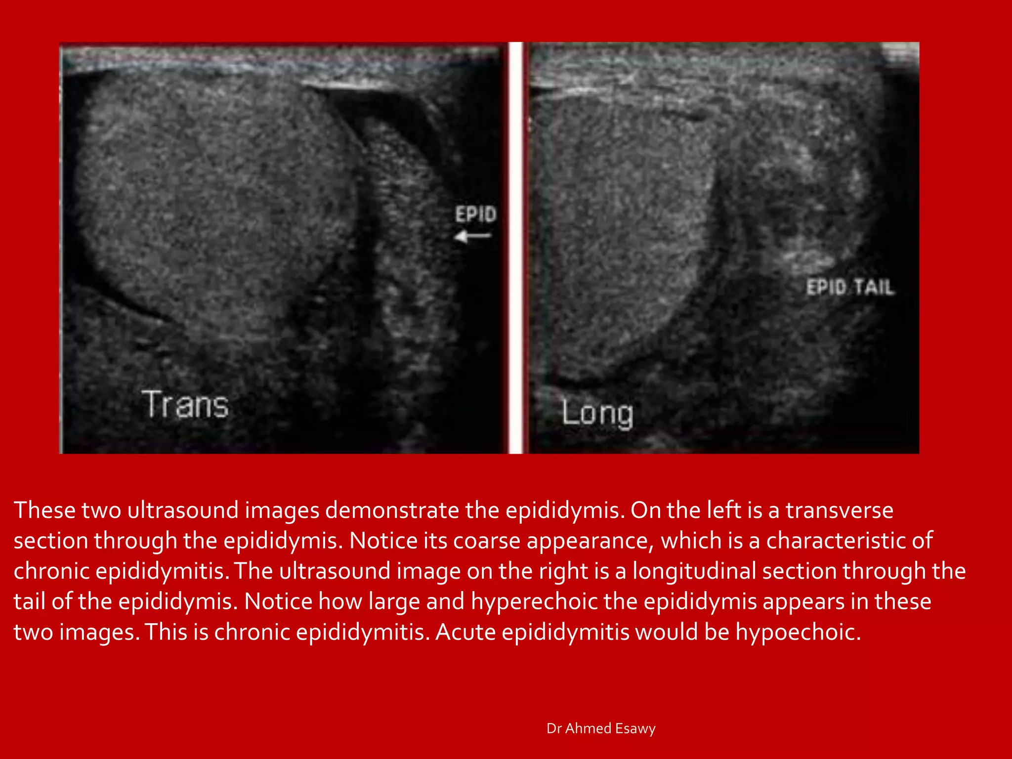 Imaging orchitis epidydmitis epidydmo orchitis DrAhmed Esawy | PDF