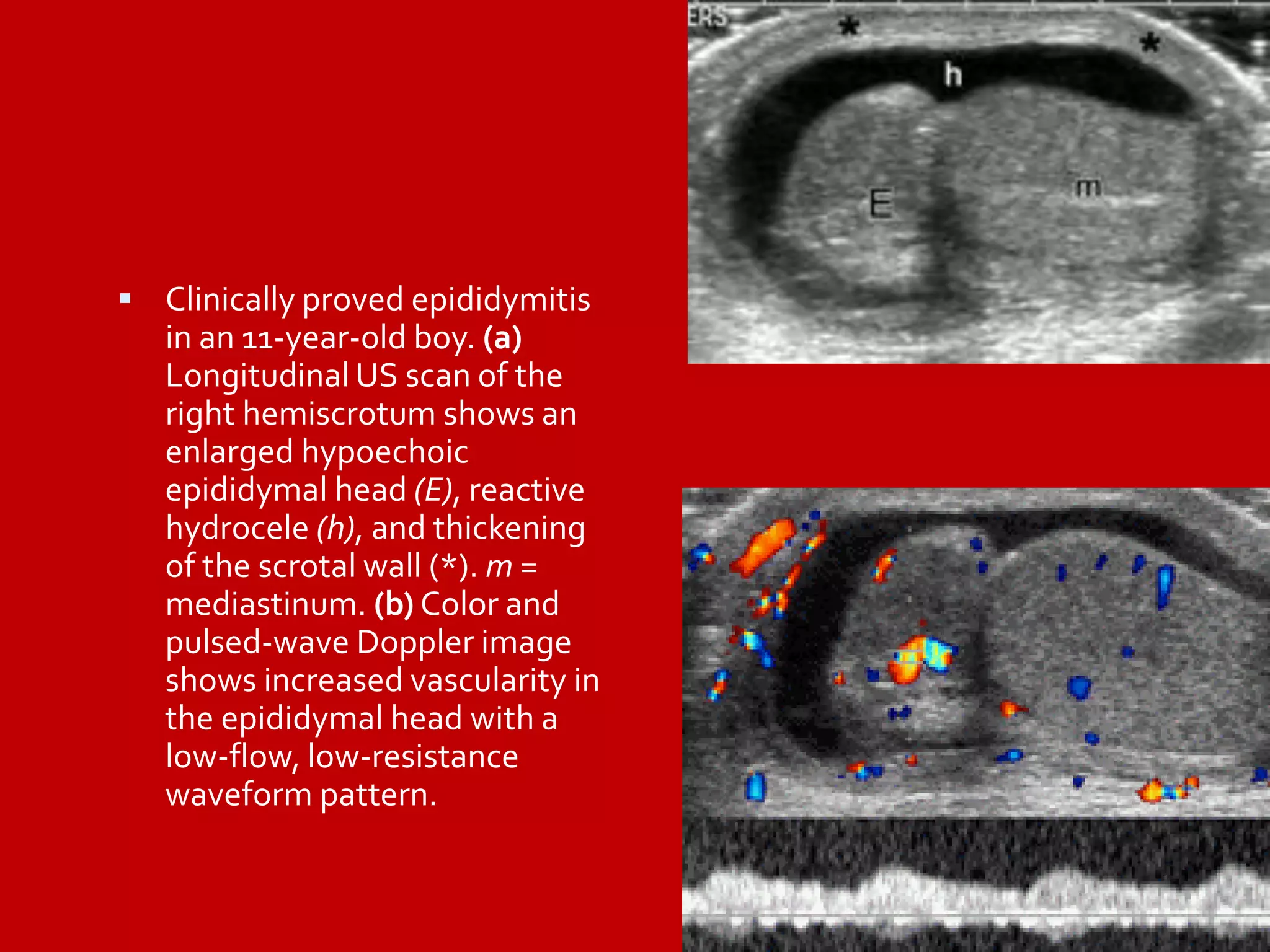 Imaging orchitis epidydmitis epidydmo orchitis DrAhmed Esawy | PDF