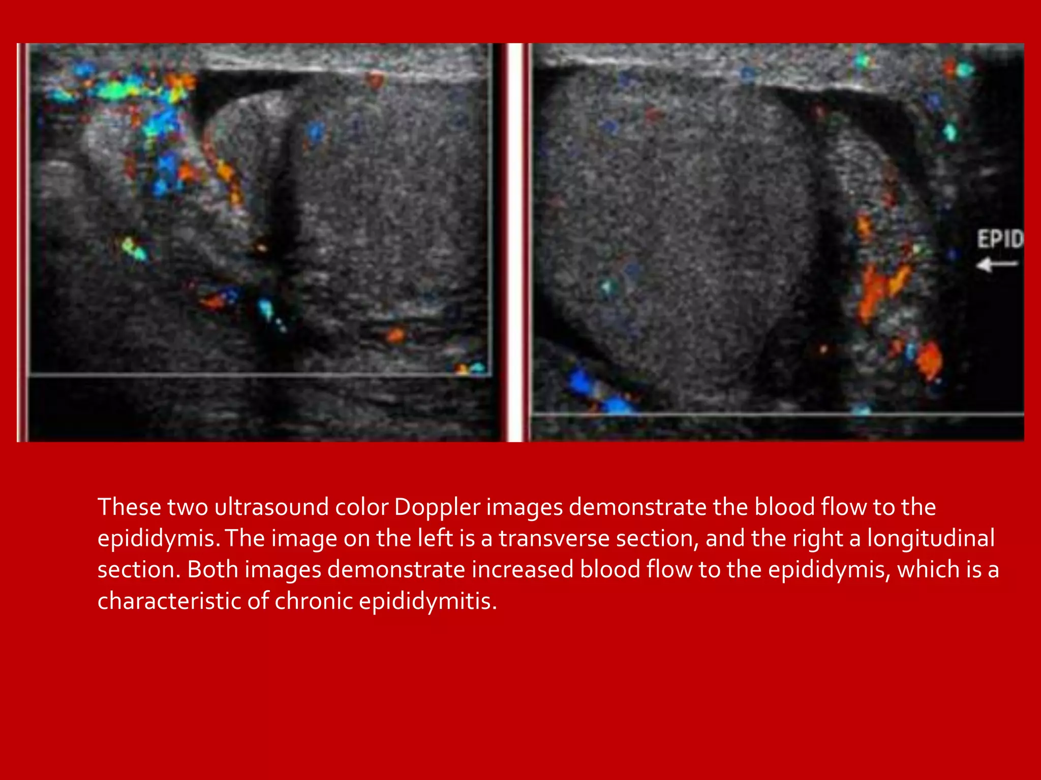 Imaging orchitis epidydmitis epidydmo orchitis DrAhmed Esawy | PDF