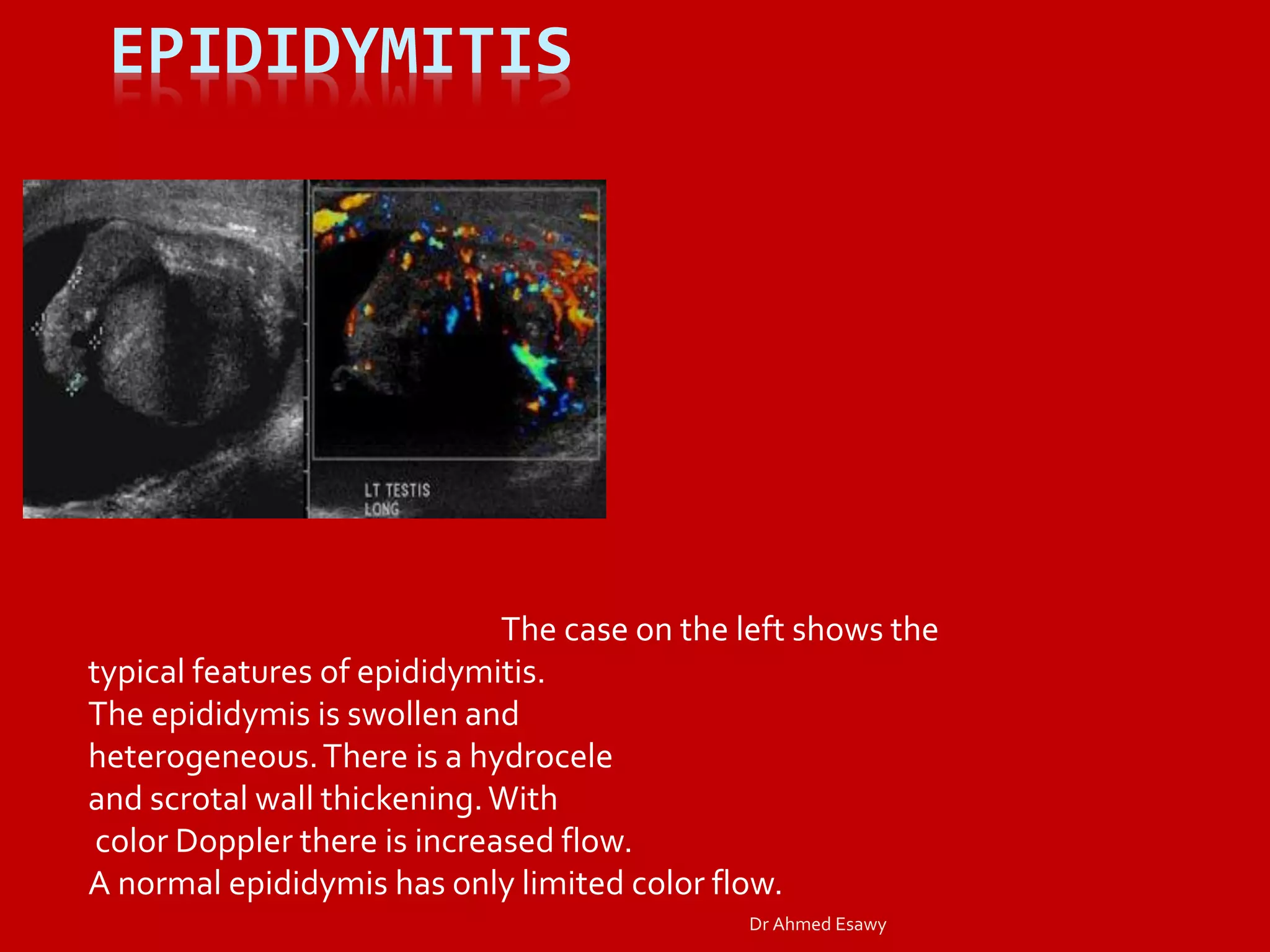 Imaging orchitis epidydmitis epidydmo orchitis DrAhmed Esawy | PDF