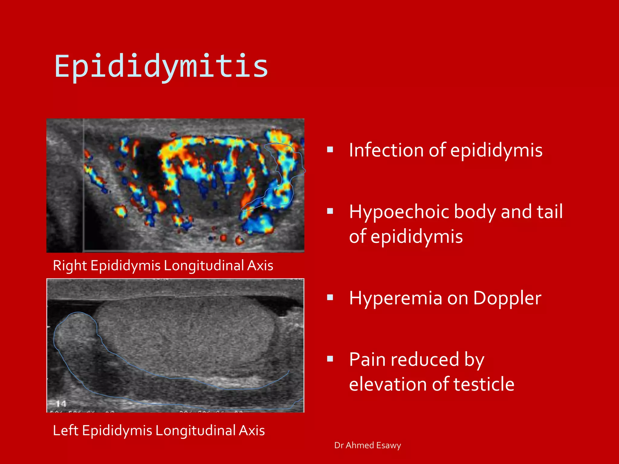 Imaging orchitis epidydmitis epidydmo orchitis DrAhmed Esawy | PDF