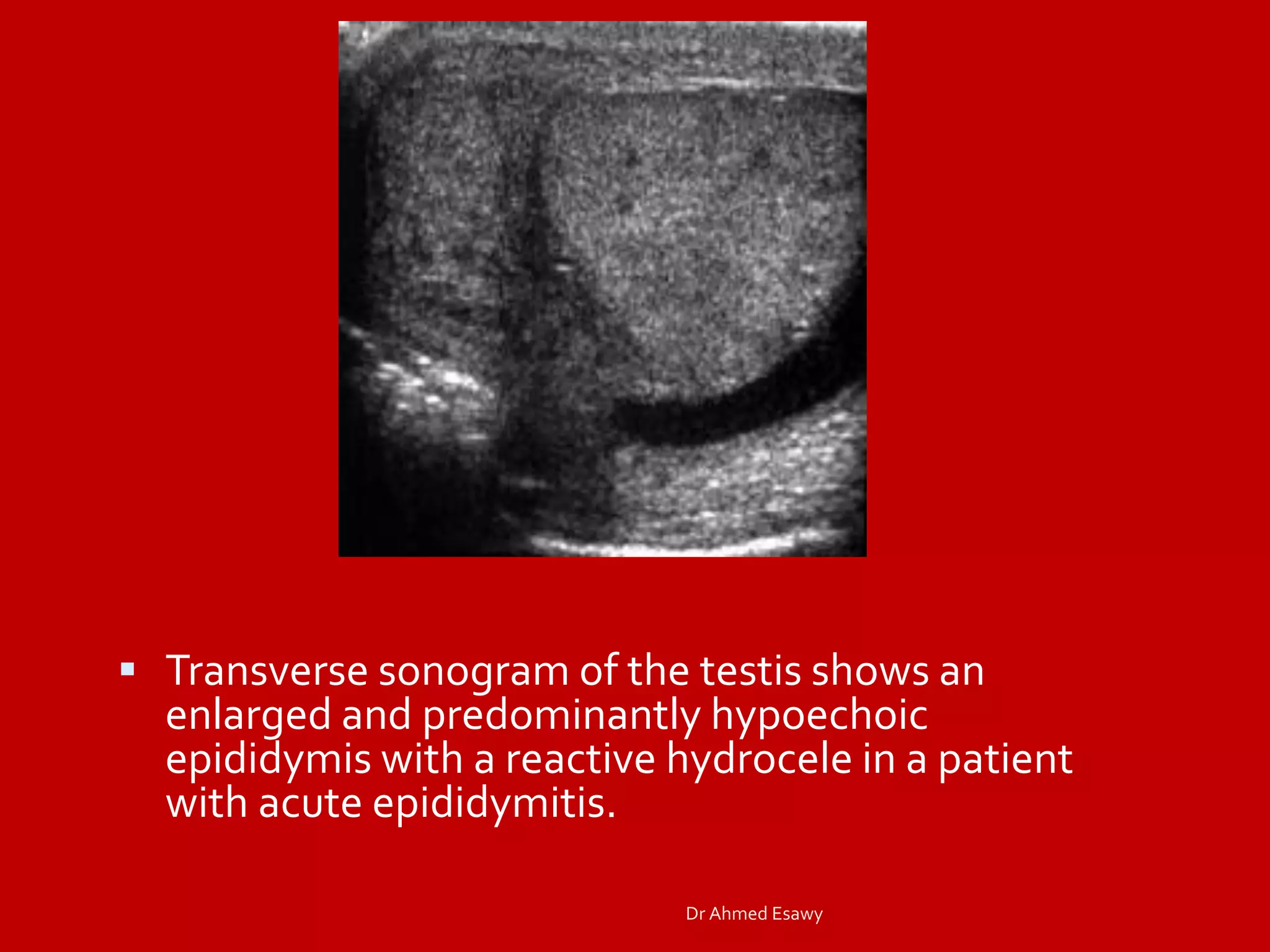 Imaging orchitis epidydmitis epidydmo orchitis DrAhmed Esawy | PDF